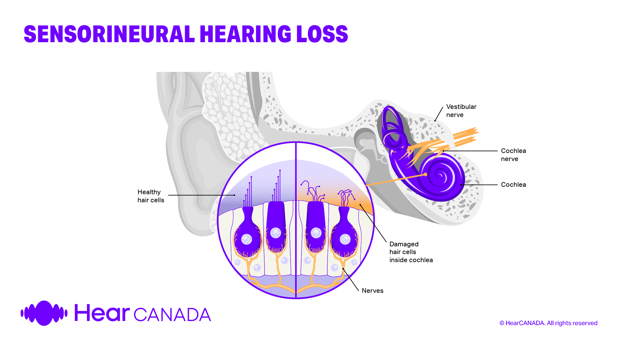 What is sensorineural hearing loss? Causes, signs & treatment